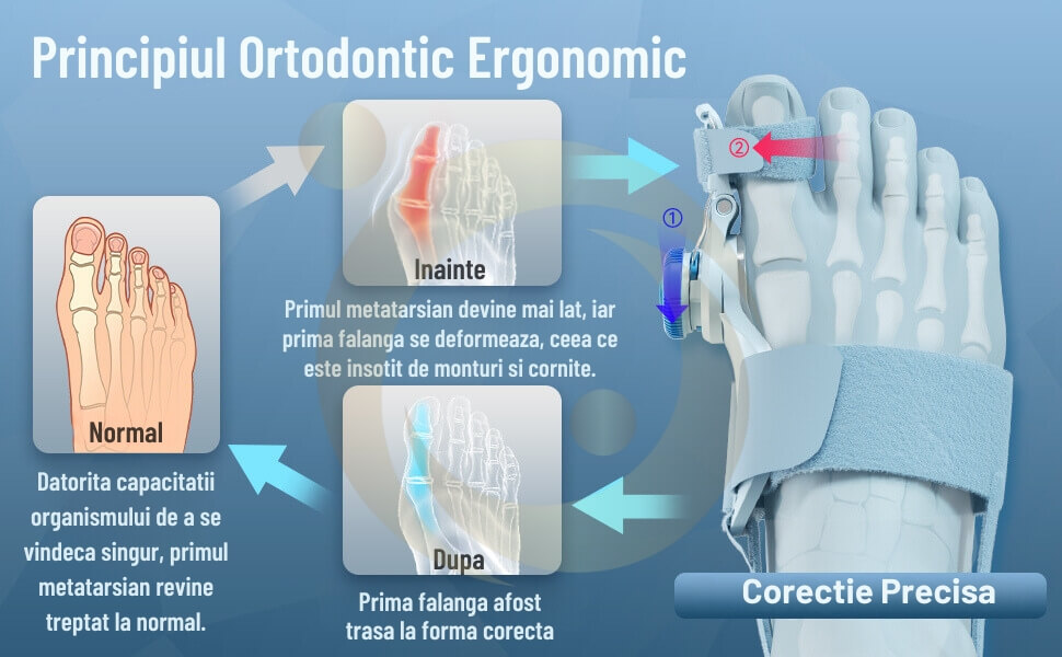 Corector Monturi de Zi si Noapte pentru picioare, Hallux Valgus, Cu ...